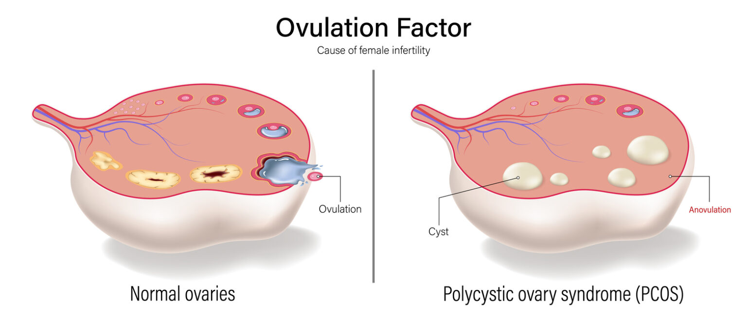 Síndrome Do Ovário Poliquístico Sintomas E Diagnósticos 8069